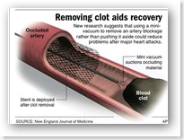 Removing clot aids heart attack recovery - vacuum procedure - Medical Quack